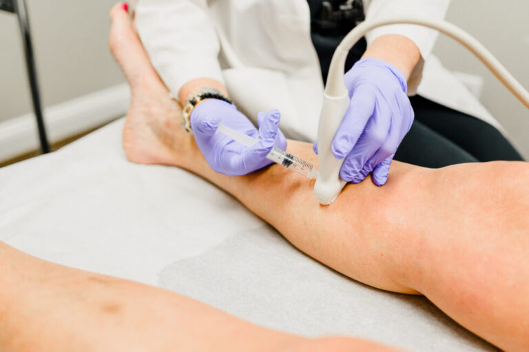 Radiofrequency Ablation (RFA) for Varicose Veins Explained - Carolina Vein Care