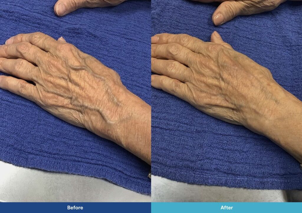 Hand Veins Before & After - Carolina Vein Care