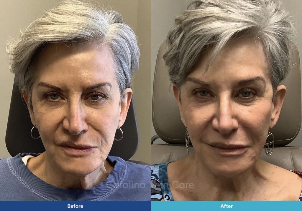 Injectables - Carolina Vein Care