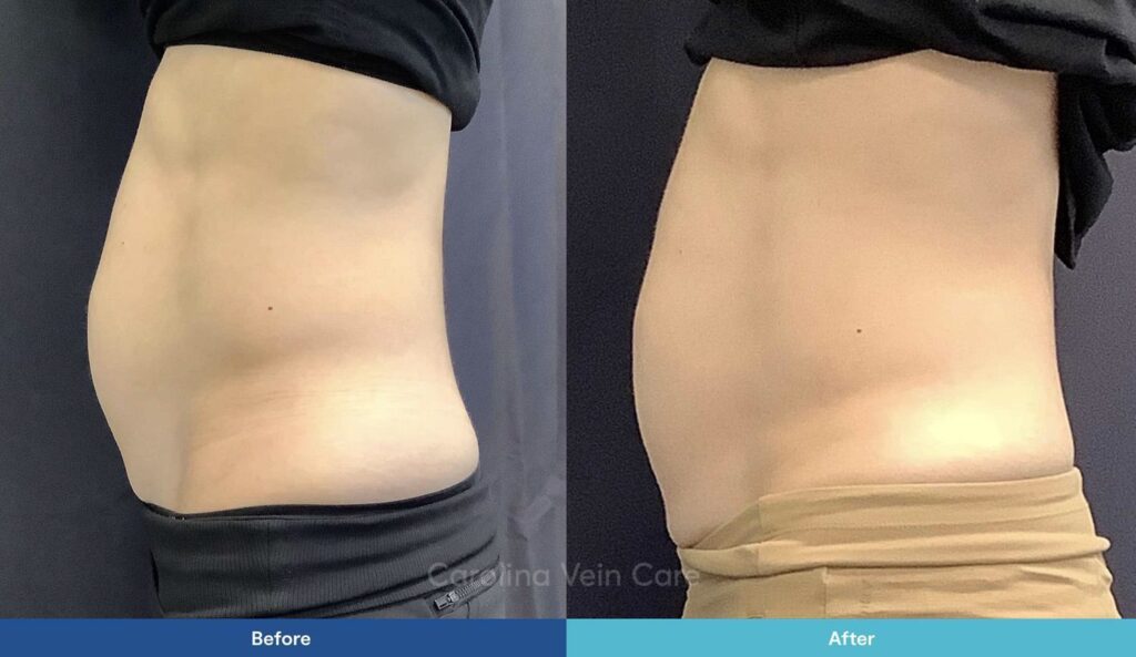 Laser Liposuction with SculpSure with Dr. Julie Park in Simpsonville