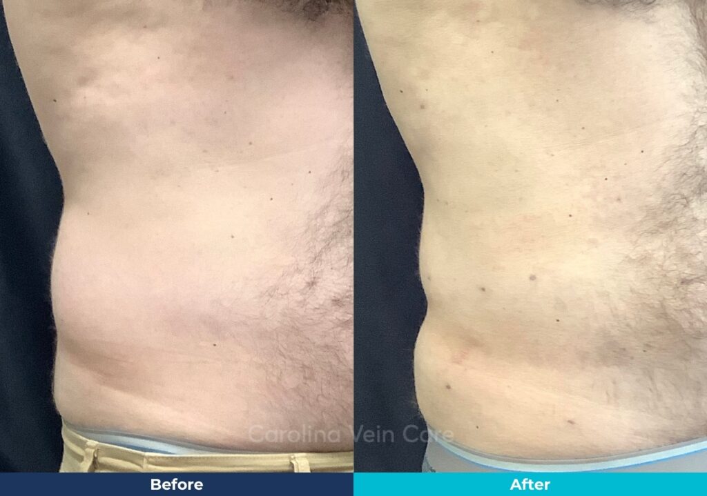 Tumescent Liposuction Before After Photo Gallery By Dr Park