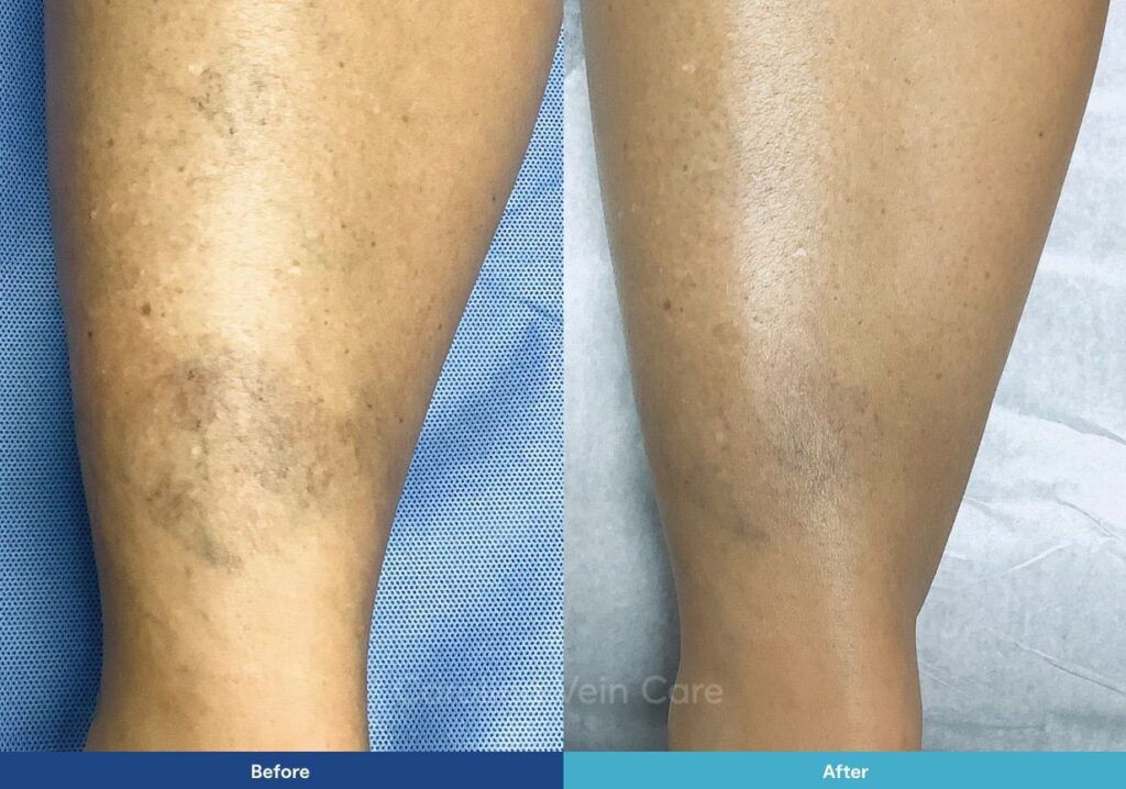 Spider Veins Before & After - Carolina Vein Care